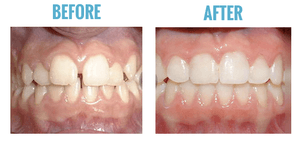 Smile Direct Club: Get the Full Scoop + Reviews